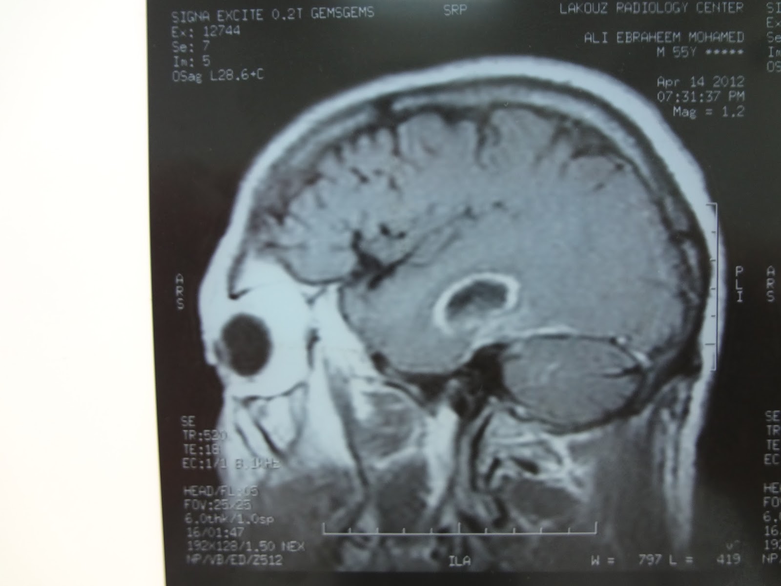 lt temporal lobe abscess complicating attico antral cholesteatoma MRI ...