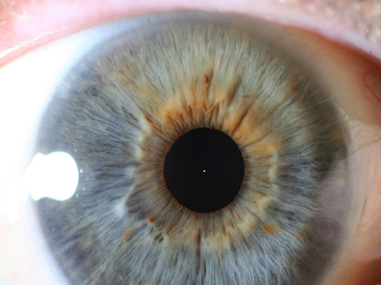 Modern & Multidimensional Iridology: Atrophy of the IPB, Stomach Ring ...