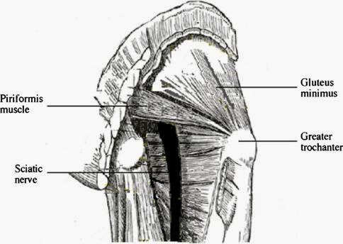 Sindrome do Piriforme