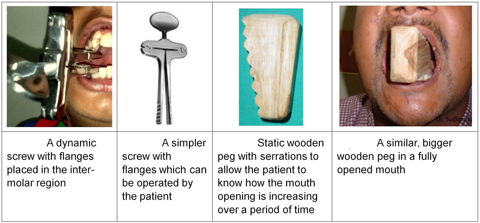 VASTRAL PHYSIOTHERAPY CLINIC: ORAL SUB MUCOUSAL FIBROSIS ...