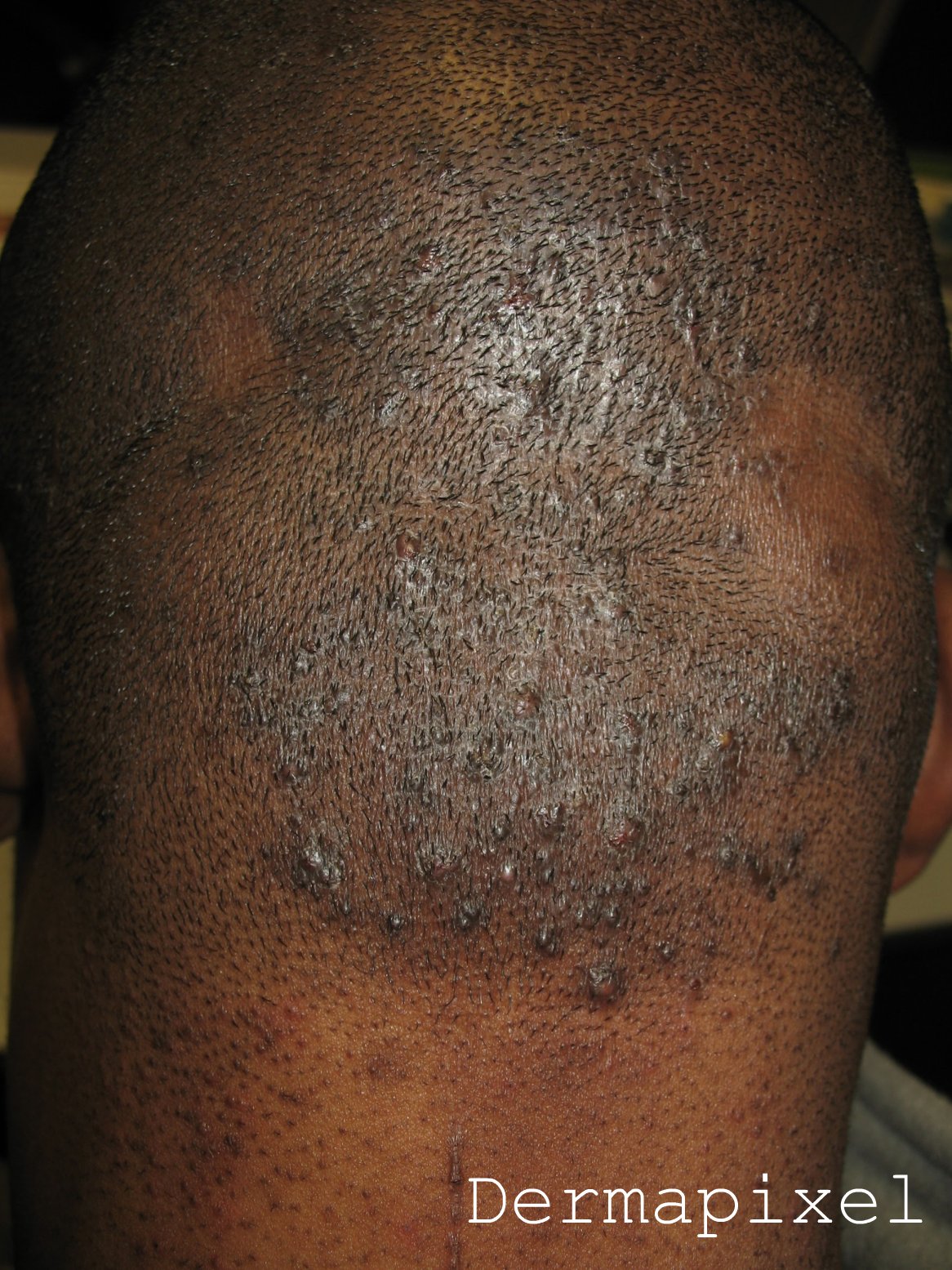 Dermapixel: Acné queloideo de la nuca: un problema complicado