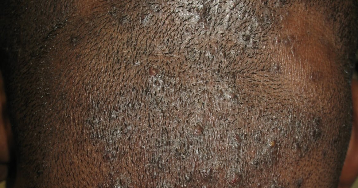 Dermapixel: Acné queloideo de la nuca: un problema complicado