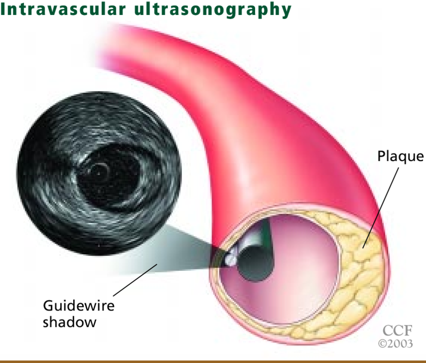 MEDICINE: Utility of intravascular ultrasound in peripheral ... MEDICINE: Utility of intravascular ultrasound in peripheral ...
