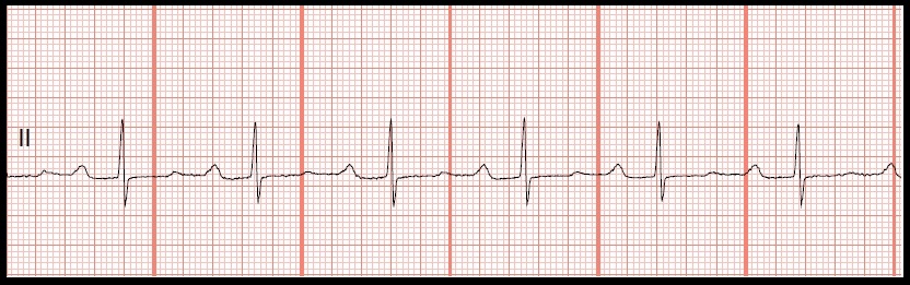 EKG Rhythm Strip Quiz 135