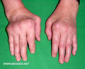 Reumatoidni artritis: Kako izgleda klinička slika RA?