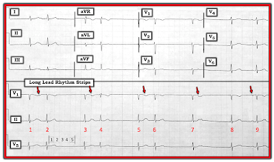 ECG Interpretation: ECG Blog #163 (Escape-Capture - Wenckebach - SA Block)