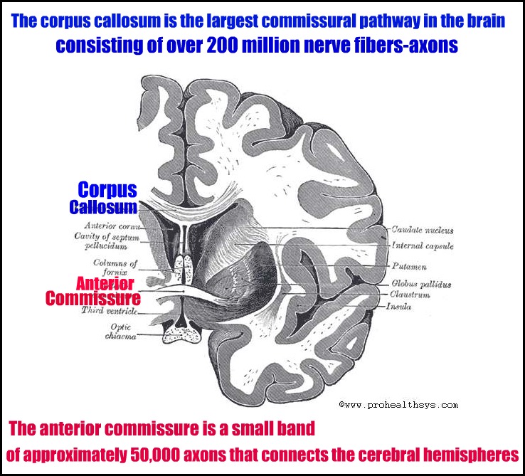 Agenesis Corpus Callosum: Dr. Sherr talks about ACC