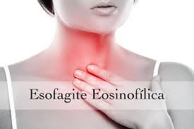 Esofagite - Inflamação Do Esôfago - Saúde & Conhecimento