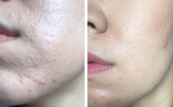 Fungal acne dan Malassezia Folliculitis