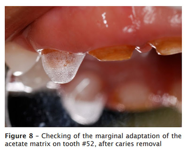 PDF: ORAL REHABILITATION of patient with severe early childhood caries ...