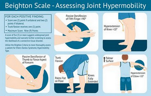 Ehlers Danlos Syndrome Pictures | Medical Pictures and Images - (2023 ...