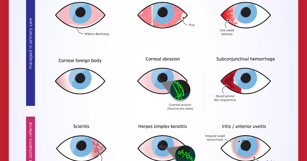 Types of Red Eye