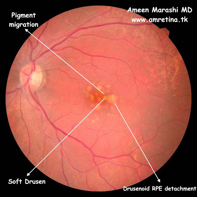 Drusen in non-neovascular ARMD and subtypes