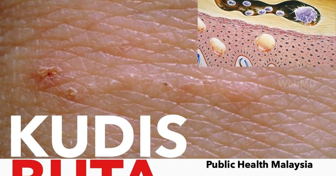 Kenali Kudis Buta, Punca, Cara Berjangkit dan Kaedah Rawatan - Layanlah ...