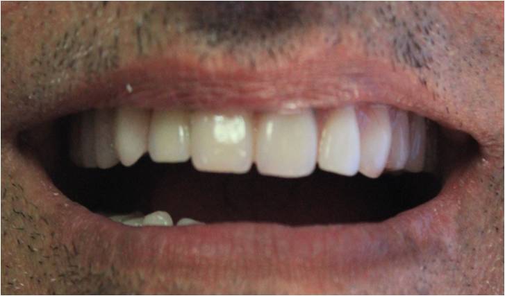 Basal dental implants cost: UPPER AND LOWER FULL ARCH RESTORATION WITH ...