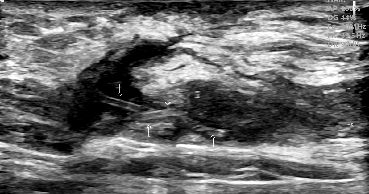 Abscesos Pared Abdominal con Cuerpos Extraños