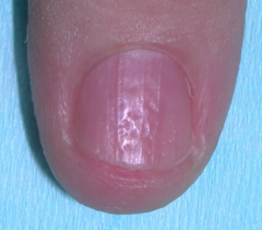 Nail pitting: Nail Pitting Psoriatic Arthritis