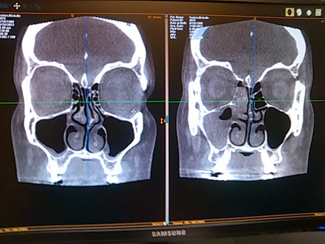 Sinus Surgery, Recovery, and What I've learned | So Here's My Life...