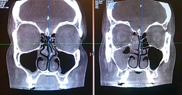 Sinus Surgery, Recovery, and What I've learned | So Here's My Life...