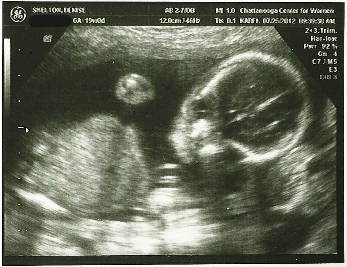 Arrows in Our Hand: 19 Week Ultrasound