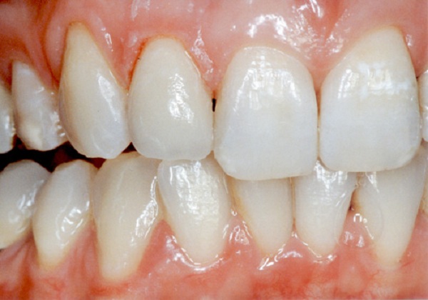 Tips for Health: Experience Of A Man Who Cured Paradentosis