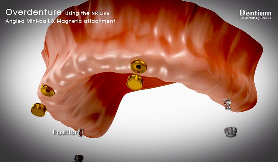 CLINICAL CASE: Implant supported Mx.overdenture (Using magnetic ...