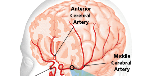 Apakah itu (TIA) Transient ischemic Attack ~ akufisio.blogspot