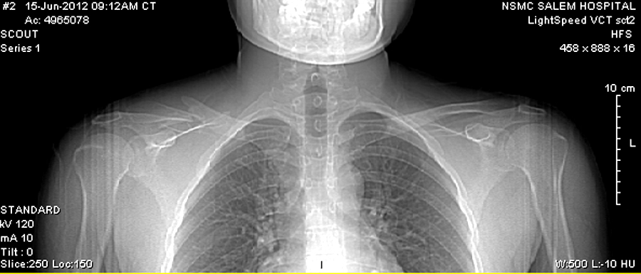 Clavicle: Surgery Recap | PastryWeight