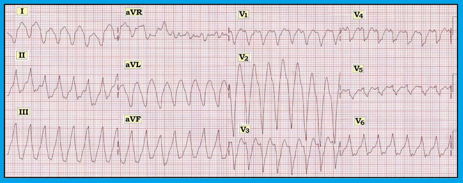 ECG Interpretation: ECG Blog #42: What Criteria? — VT vs Aberrancy?