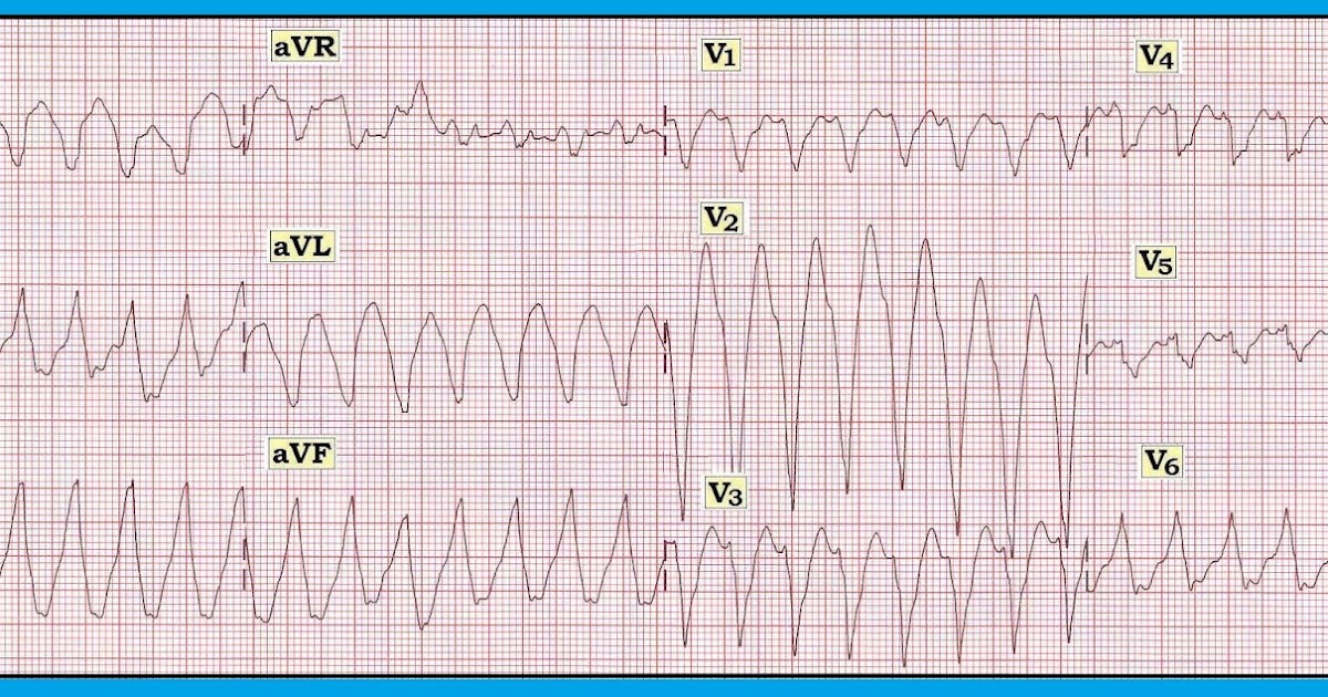 ECG Interpretation: ECG Blog #42: What Criteria? — VT vs Aberrancy?