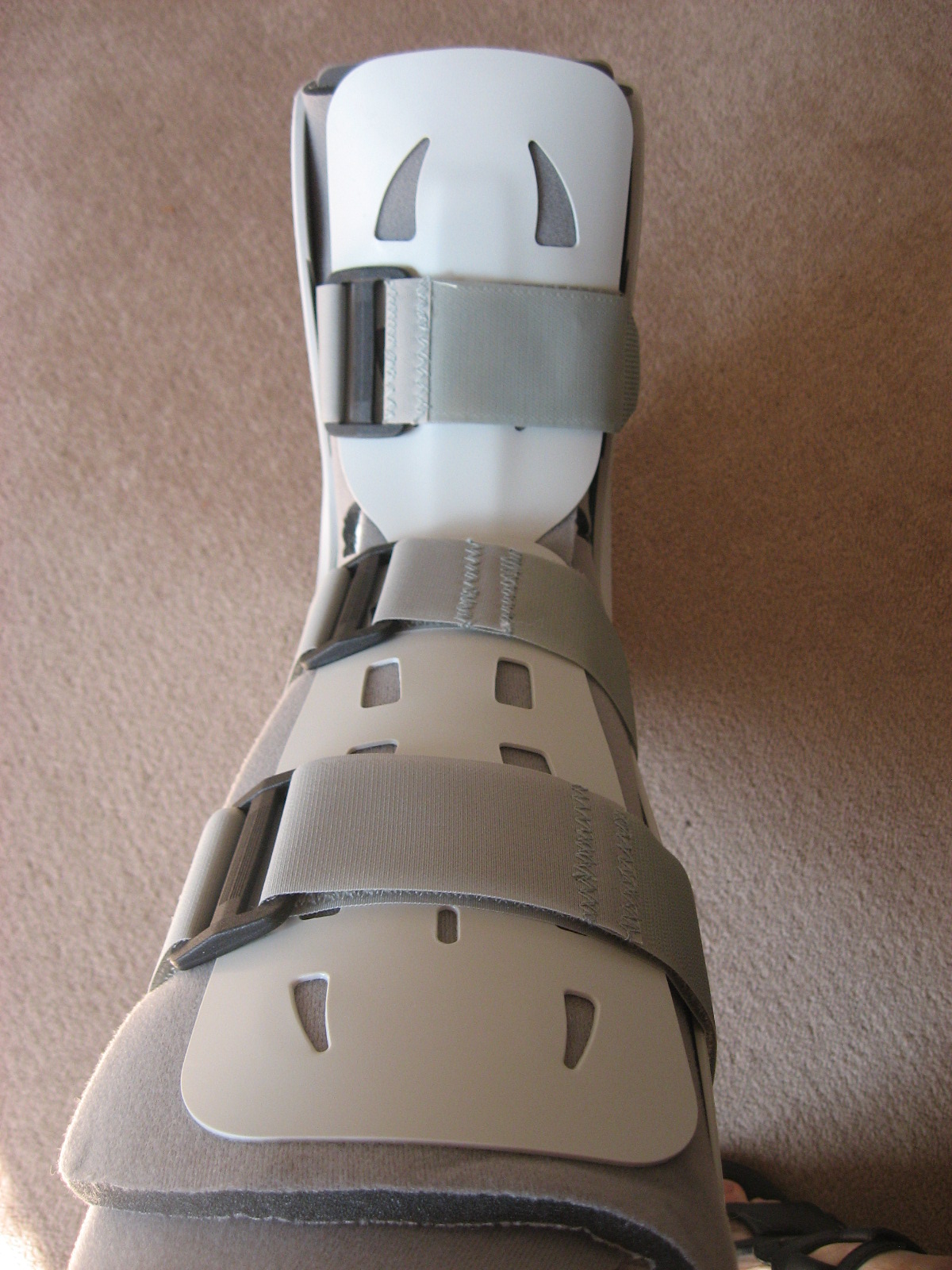 Achilles rupture - My Story..... | Achilless Rupture, my experience and ...