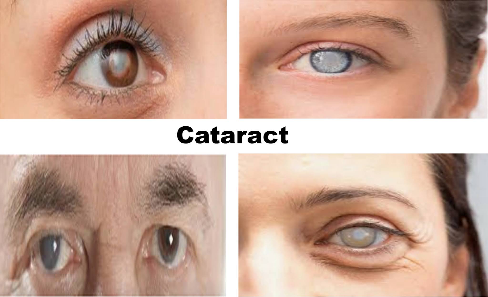Cataract: Causes, Symptoms, Types, Tests, Prevention, and Treatment.