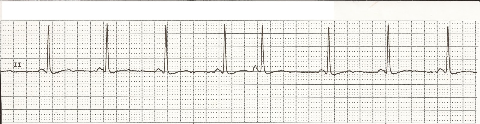 EKG Rhythm Strip Quiz 57: Ectopic Beats