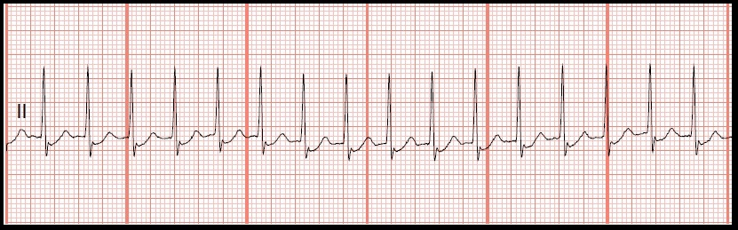 Practice EKG Rhythm Strips 123