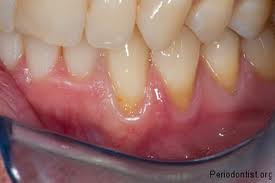 FAMILY CARE DENTAL: Over brushing ‘damages teeth’