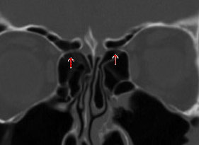 Tutorials in otolaryngology: Anatomy of anterior ethmoidal artery