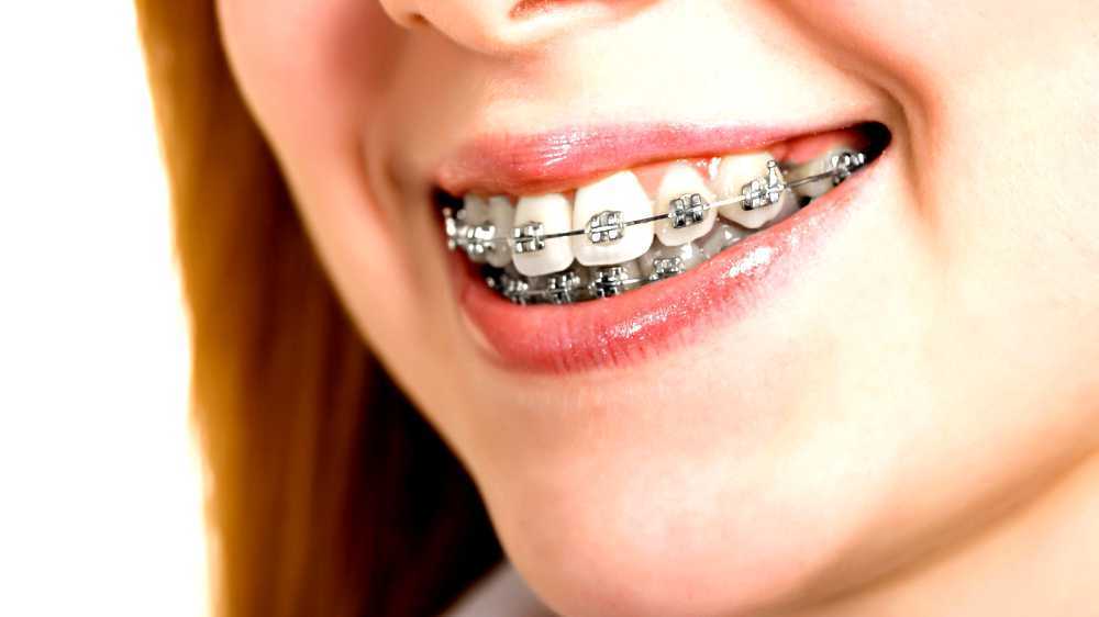 Dental braces