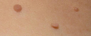Photos of Skin Tags ~ How To Remove Moles, Warts, Skin Tags Safely