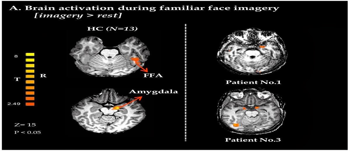 The Thoughtful Vegetable: Do Vegetative People Recognize Loved Ones?