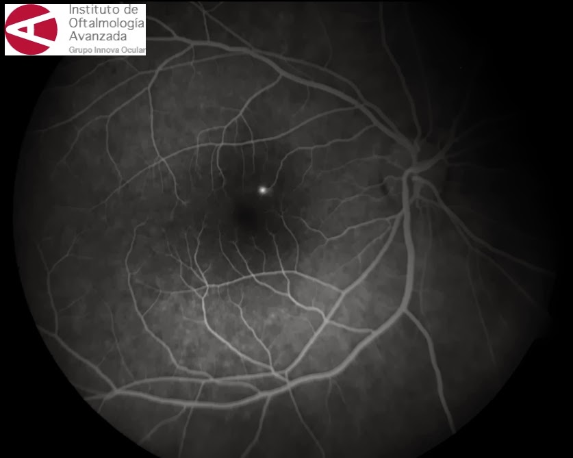 Miranza IOA: COROIDOPATÍA CENTRAL SEROSA