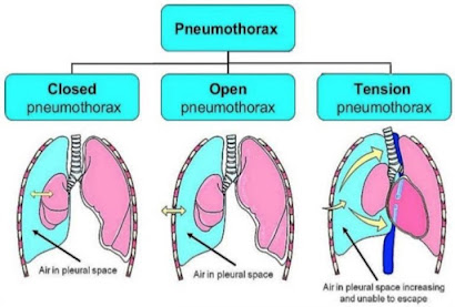 FISIOLOGÍA Y TIPOS DE NEUMOTORAX