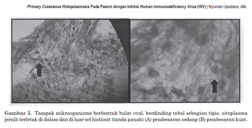 MIKOSIS SISTEMIK : HISTOPLASMOSIS DESIMINATA