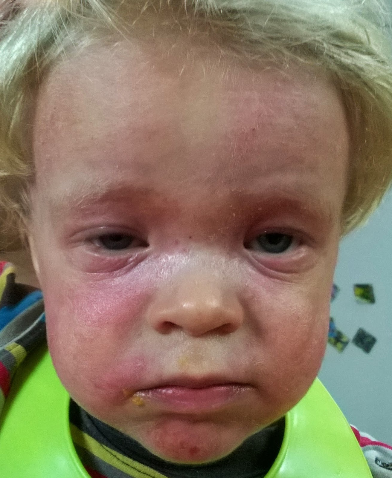 Mustikka: Kampen mot atopisk exem - part VII