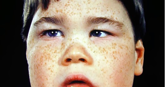 SIFAT's Disease ATLAS: FACES OF PATIENTS IN THALASSEMIA