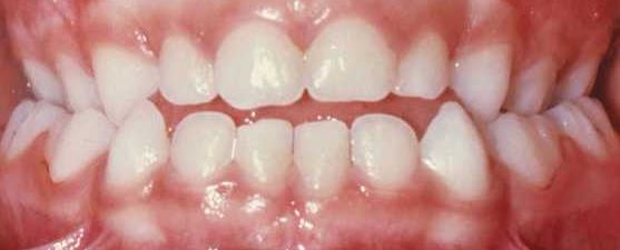Causes of Open bite, Deep bite, crowding, Generalized spacing, Midline ...