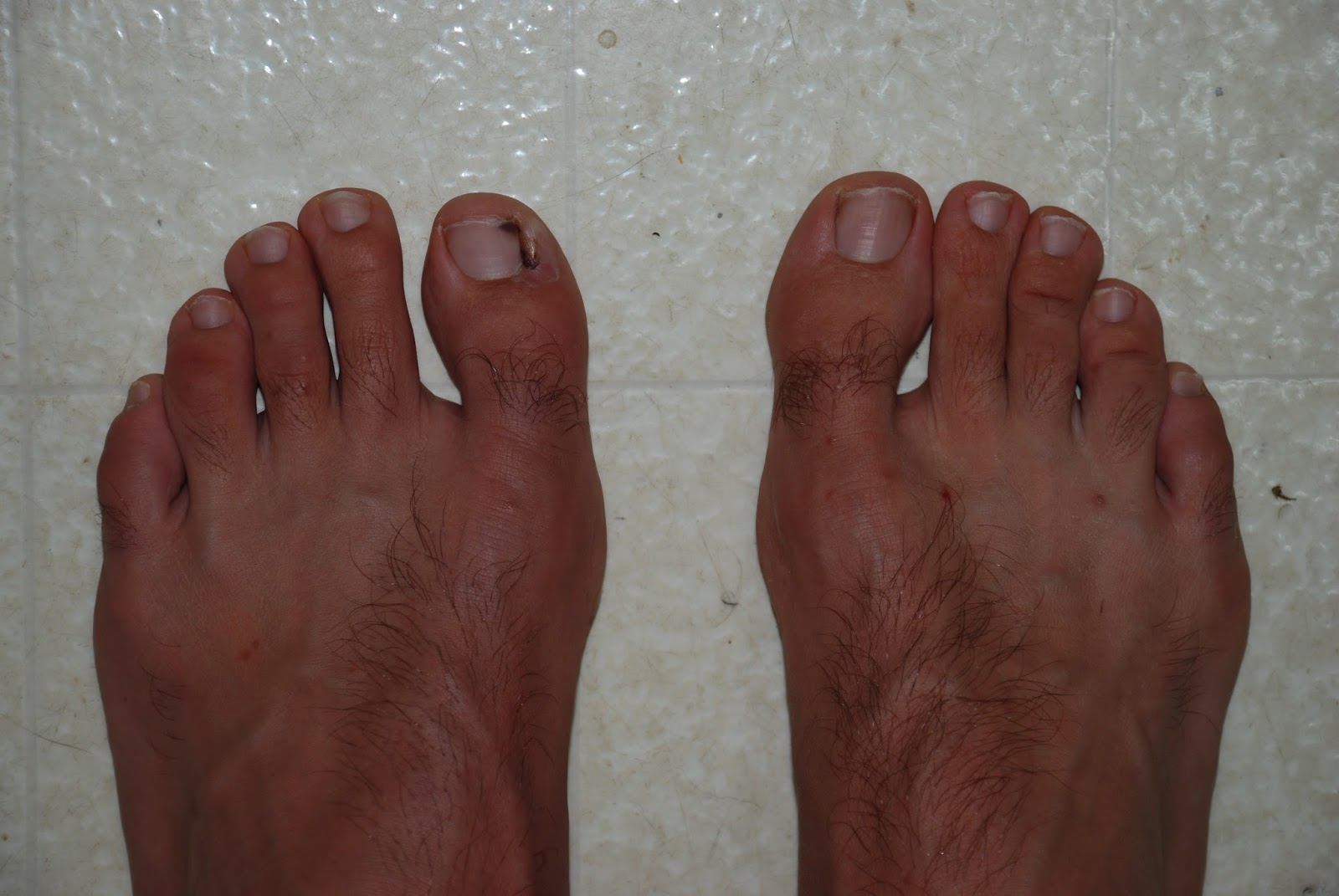 Lisfranc injury: A runners worst nightmare: The 'Gap Sign'