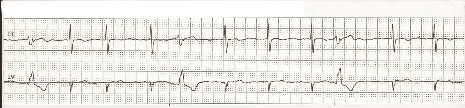 EKG Rhythm Strips: Bigeminy, Trigeminy, Quadrageminy