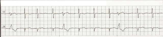 EKG Rhythm Strips: Bigeminy, Trigeminy, Quadrageminy