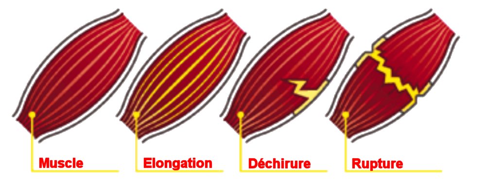 Blog 75: Infos santé-Crampes et courbatures