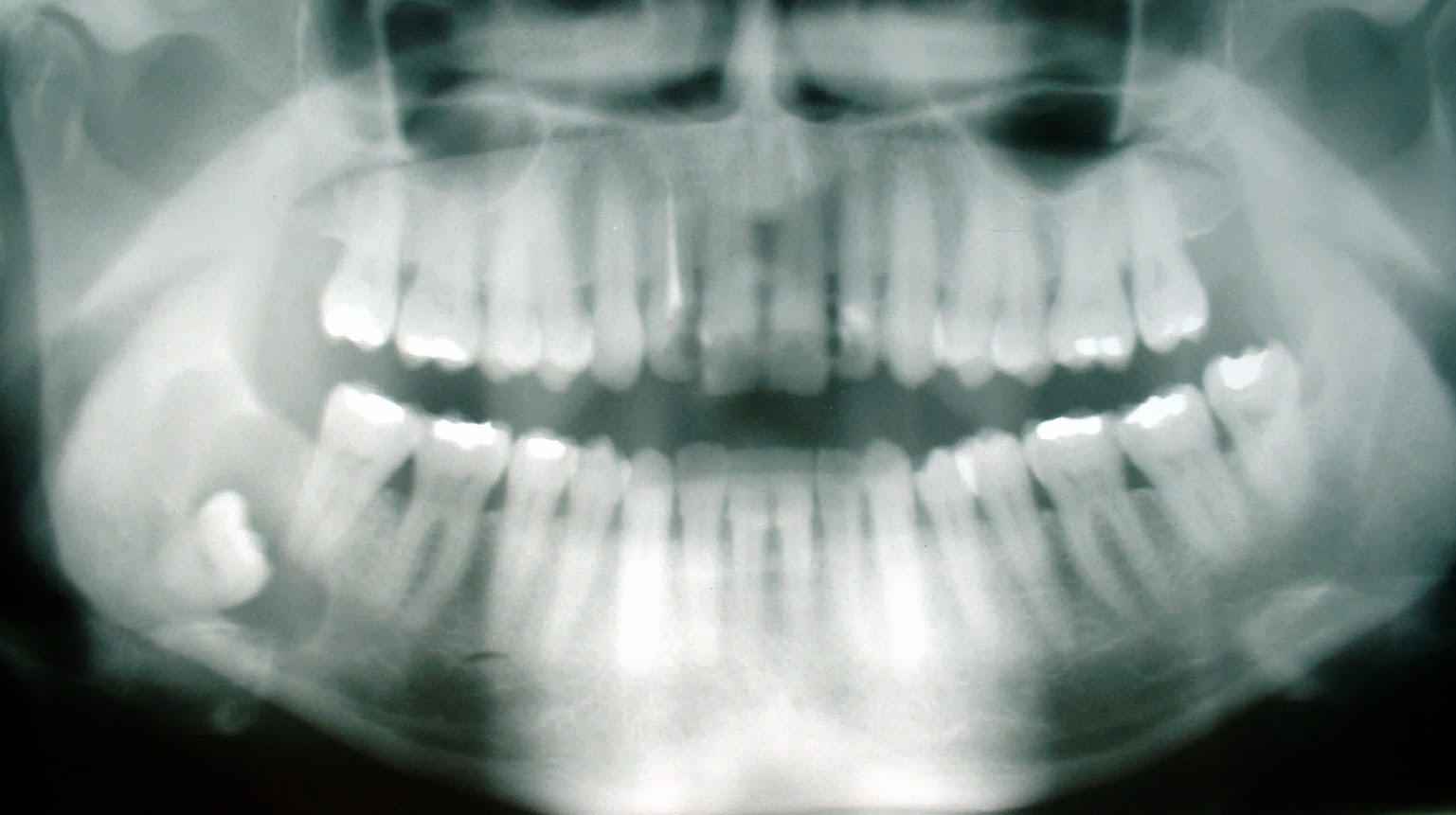 LaserDennisT Wisdom Behind The Wisdom Teeth laserdennist-wisdom-behind-the-wisdom-teeth